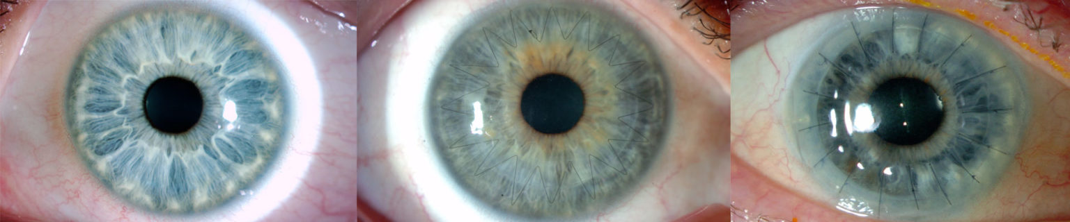 La cornée, traitements par le Centre Ophtalmologique de Lausanne.